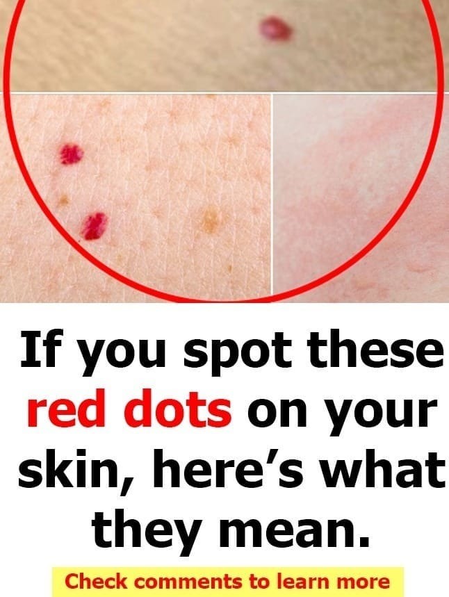 If you spot these red dots on your skin, here’s what they mean – Best ...
